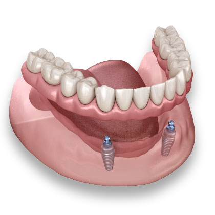 Removable Dentures on Implants - Calgary Denture Clinic - Dentures and ...